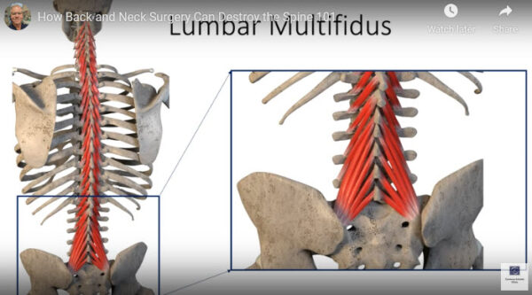 Back Surgery Part 2 – How Back and Neck Surgery can Damage the Spine